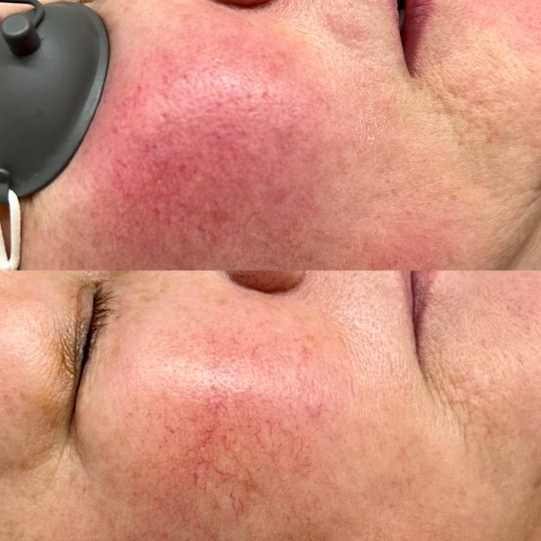 Laser Spider Vein Removal Victoria BC | Redness & Rosacea Treatment